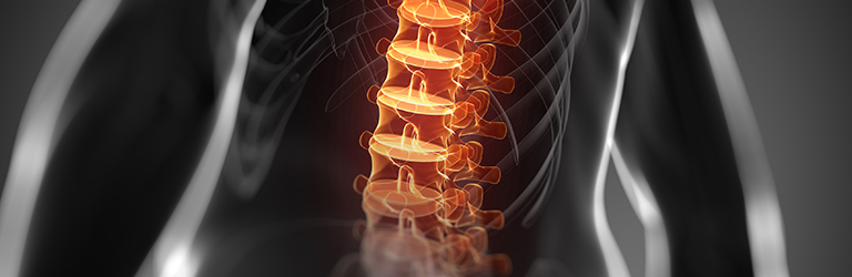 Posterior Lumbar Decompression and Fusion surgery | PLDF Surgery